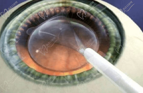 icl和ticl的区别？查看ICL和TICL晶体植入术的不同点_口腔医院牙科门诊专家在线问答_皓齿口腔网