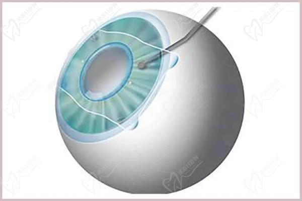 分享prl晶体植入与icl的区别,来看两种哪个更好及价格区别_口腔医院牙科门诊专家在线问答_皓齿口腔网